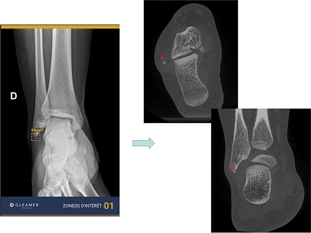 Radiographic Detection of Post-Traumatic Bone Fractures: Contribution ...