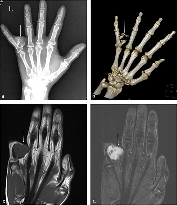 Periosteal Chondroma of the Fifth Finger | Journal of the Belgian ...