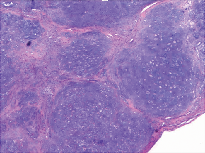 Periosteal Chondroma of the Fifth Finger | Journal of the Belgian ...