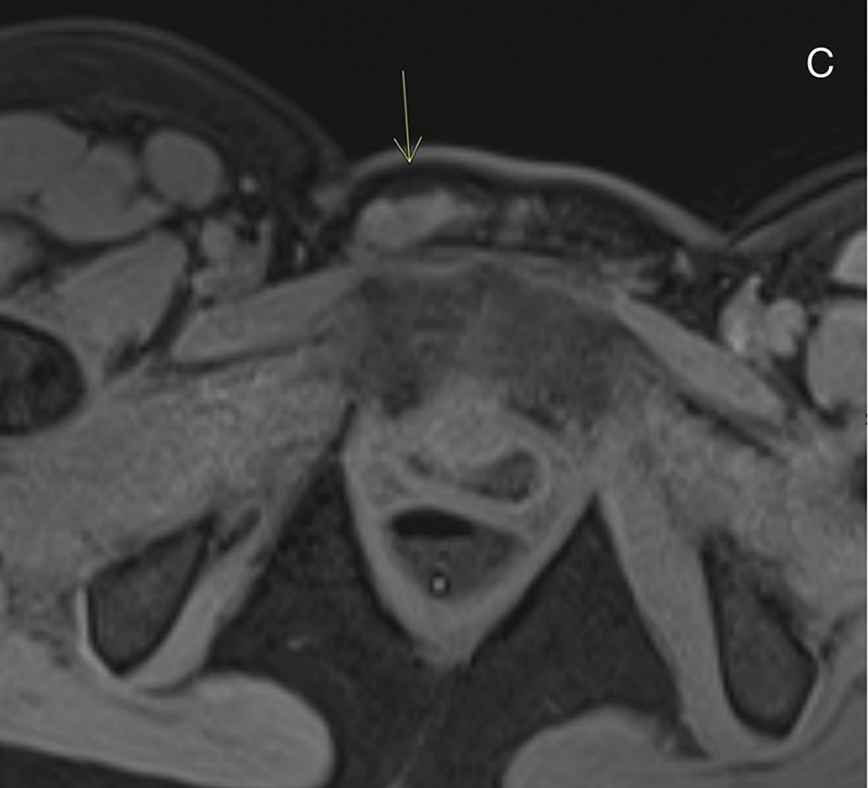 Endometriosis of the Round Ligaments in Twins: A Rare and Unique ...
