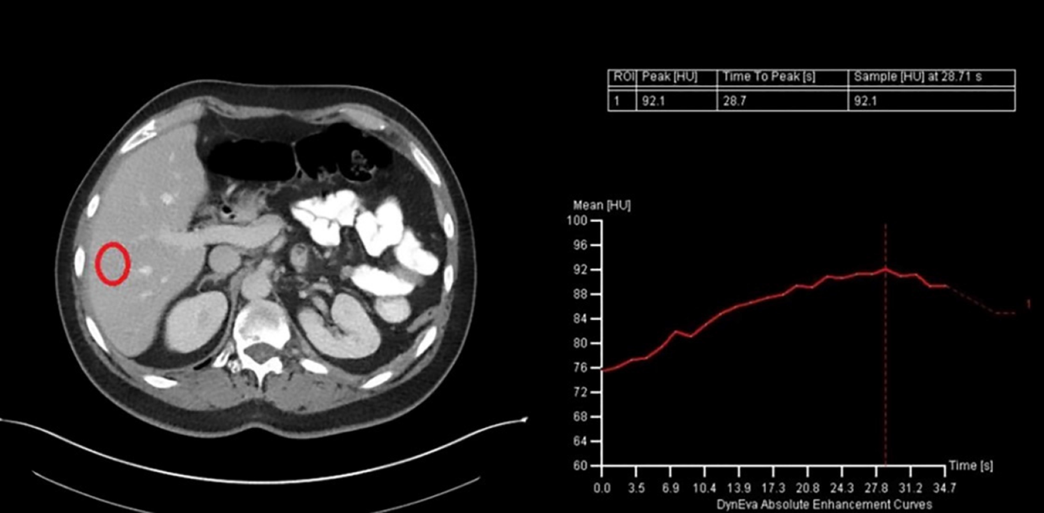 Personalized Contrast Agent Volumes in Abdominal CT: Bridging Theory ...