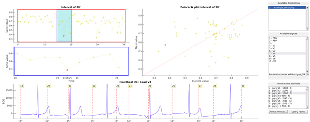 ecg-kit: a Matlab Toolbox for Cardiovascular Signal Processing ...