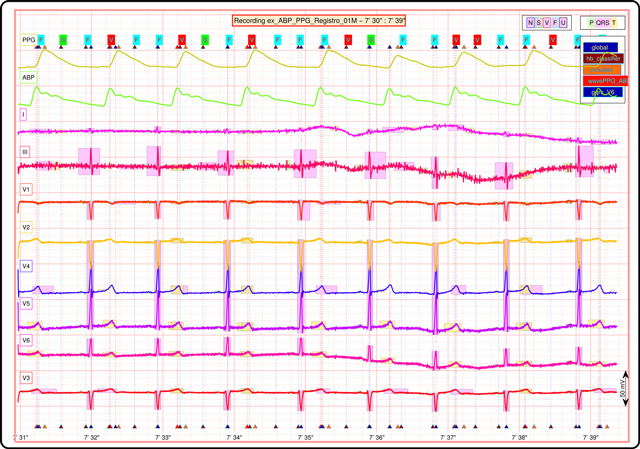 ecg-kit: a Matlab Toolbox for Cardiovascular Signal Processing ...