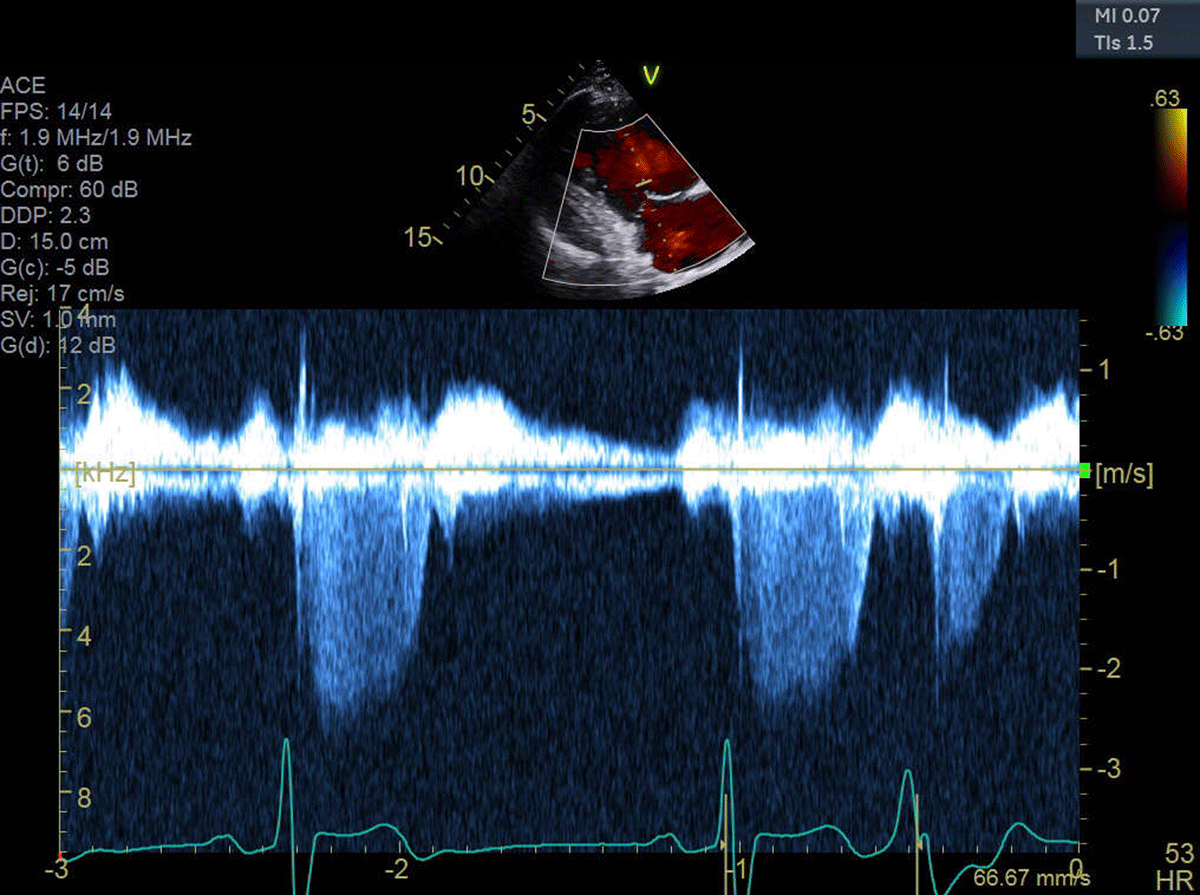 A Patient with Dyspnea and an Enlarged Right Ventricle | Methodist ...