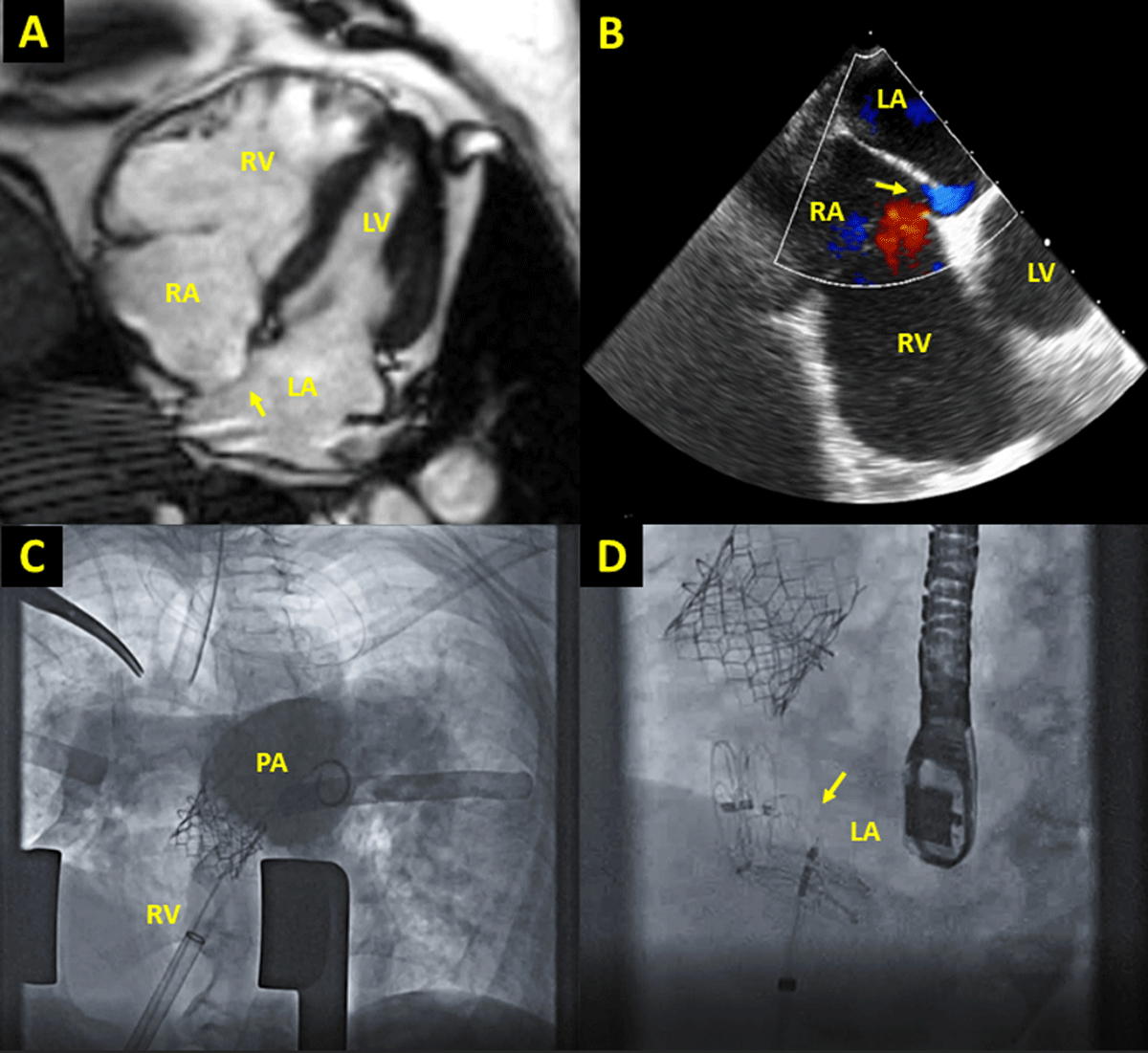 PFO Closure after Pulmonary Valve Intervention in Patients with ...
