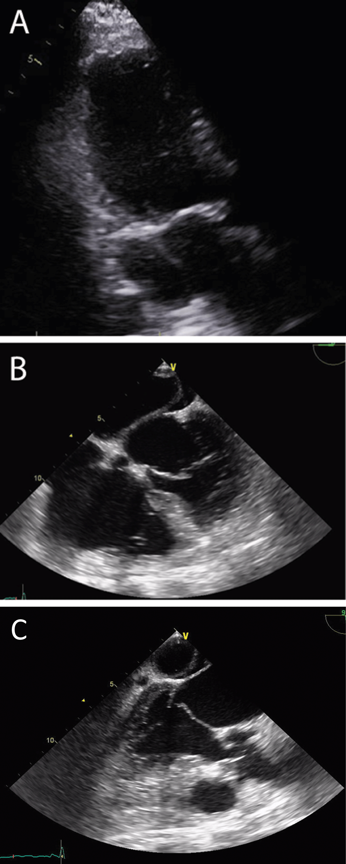 Giant Coronary Sinus Complicated by Spontaneous Thrombosis | Methodist ...