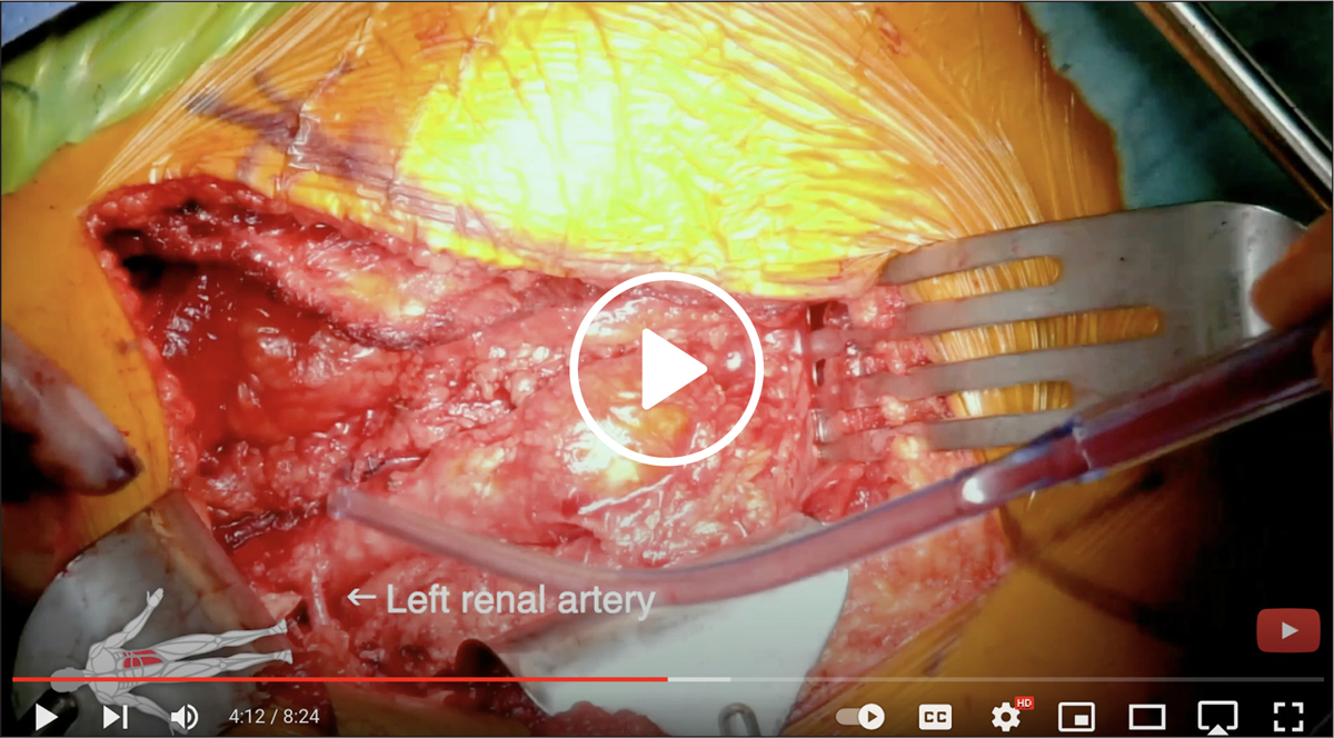 Explant of the Aortic Endograft: Today’s Solutions, Tomorrow’s Problems ...