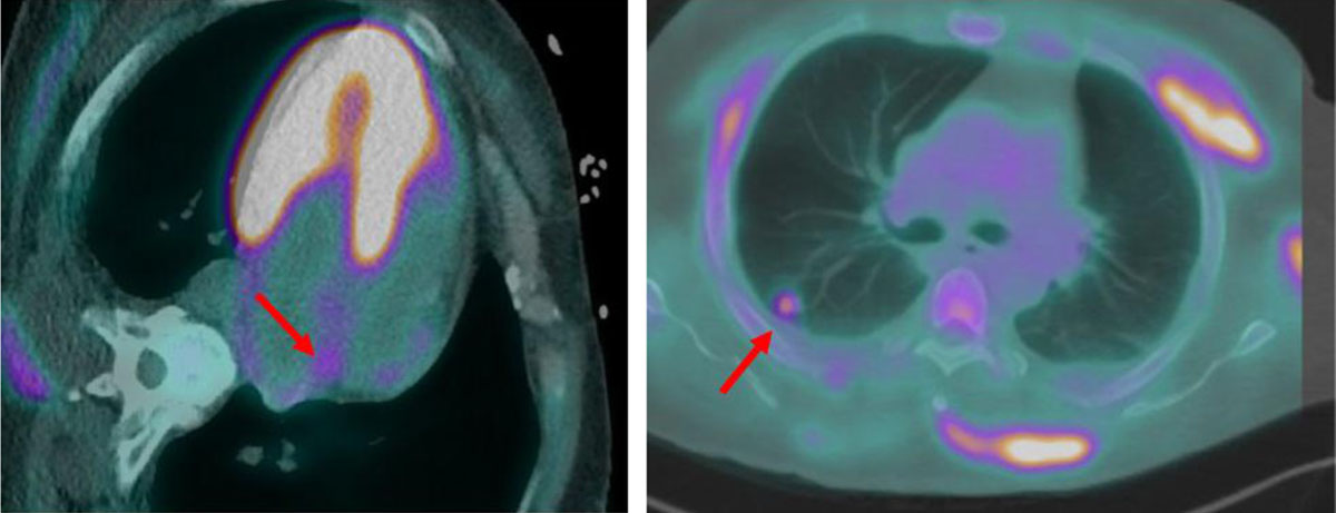 Endocarditis Presenting as Right Atrial Mass, Diagnosed with 18F ...