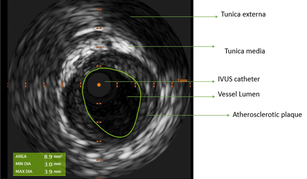 The Great Masquerade: Not All Coronary Artery Stenosis Are Created ...