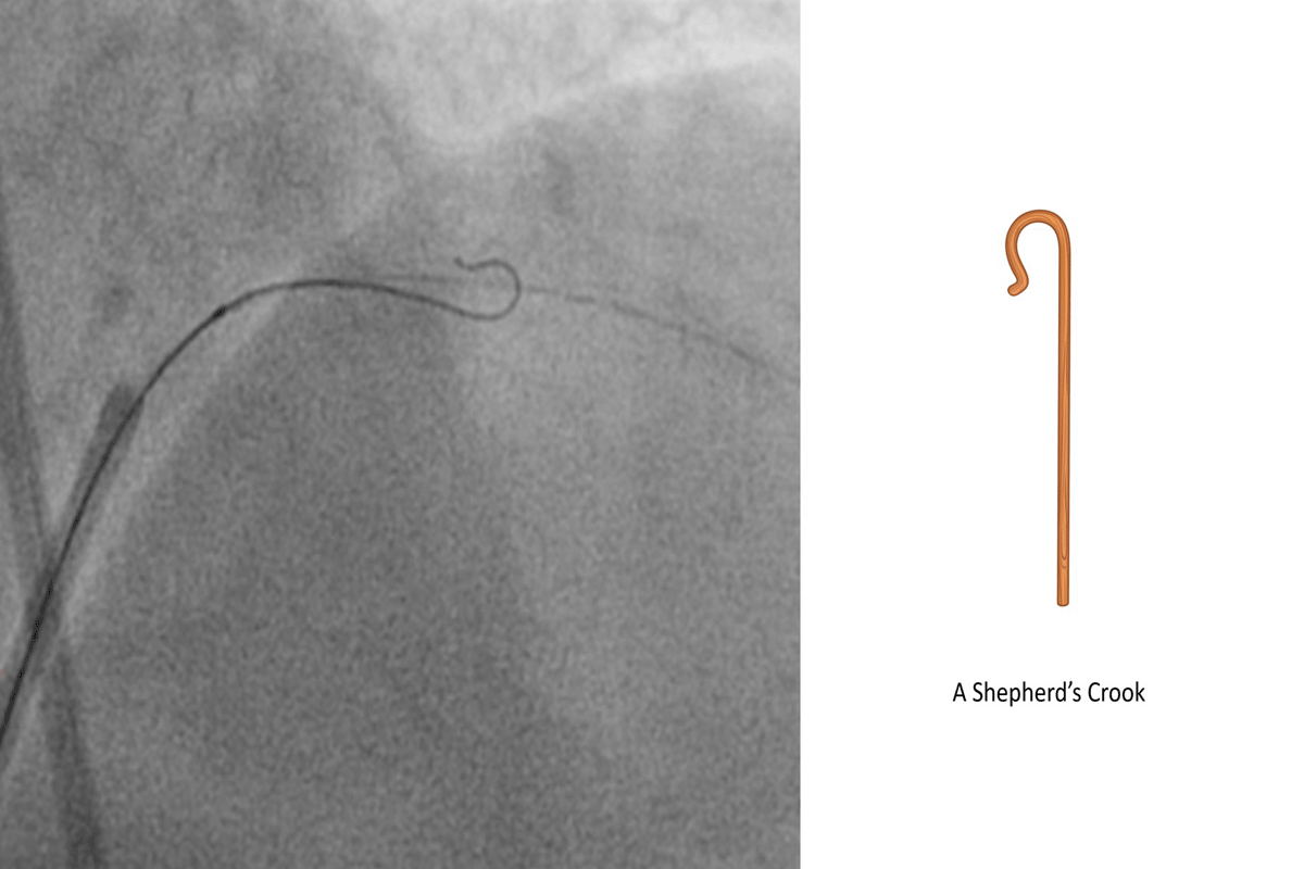 Shepherd’s Crook Curve: A Novel Technique for Angulated Side Branch ...