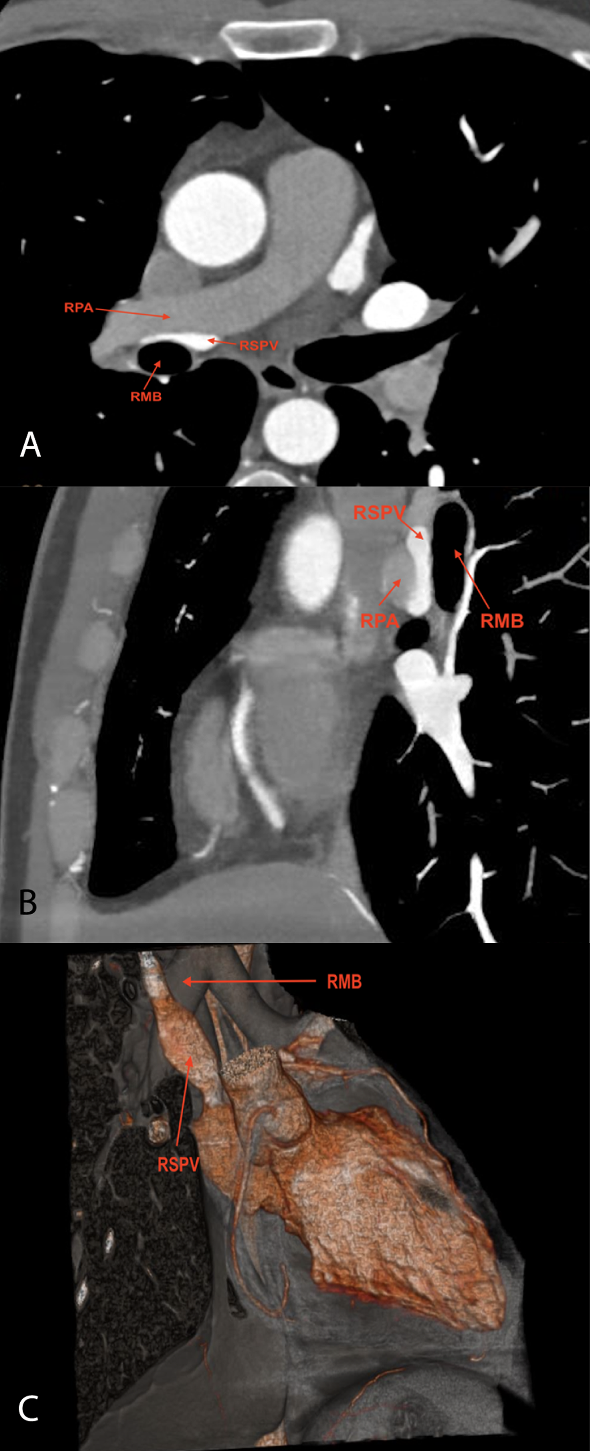Pulmonary Vein in a Pinch | Methodist DeBakey Cardiovascular J