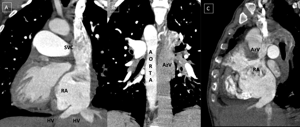 Incidental Detection of Adult Polysplenia Syndrome With Situs Inversus ...