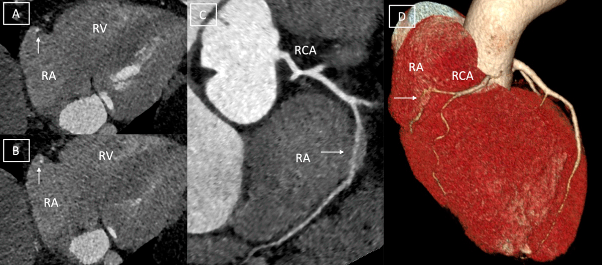 Intra-atrial Course of Right Coronary Artery: A Rare Anomaly Detected ...