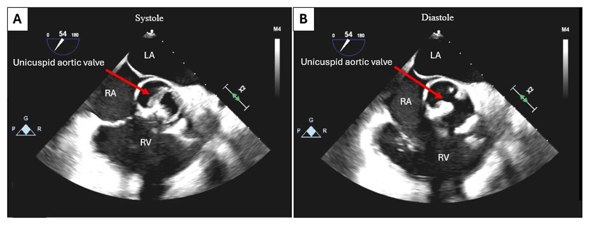 From Chronic Use of Minocycline to Pigmented Unicuspid Aortic Valve: A ...