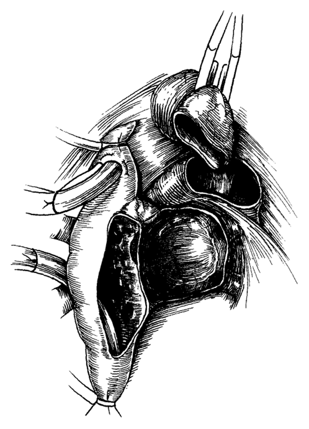 The Evolution of the Heart Transplant Surgical Technique | Methodist ...