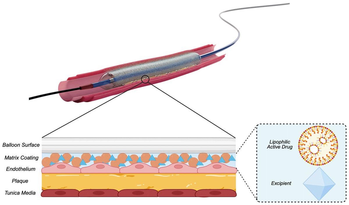 Drug-Coated Balloons for Coronary Interventions: A Focused Review ...