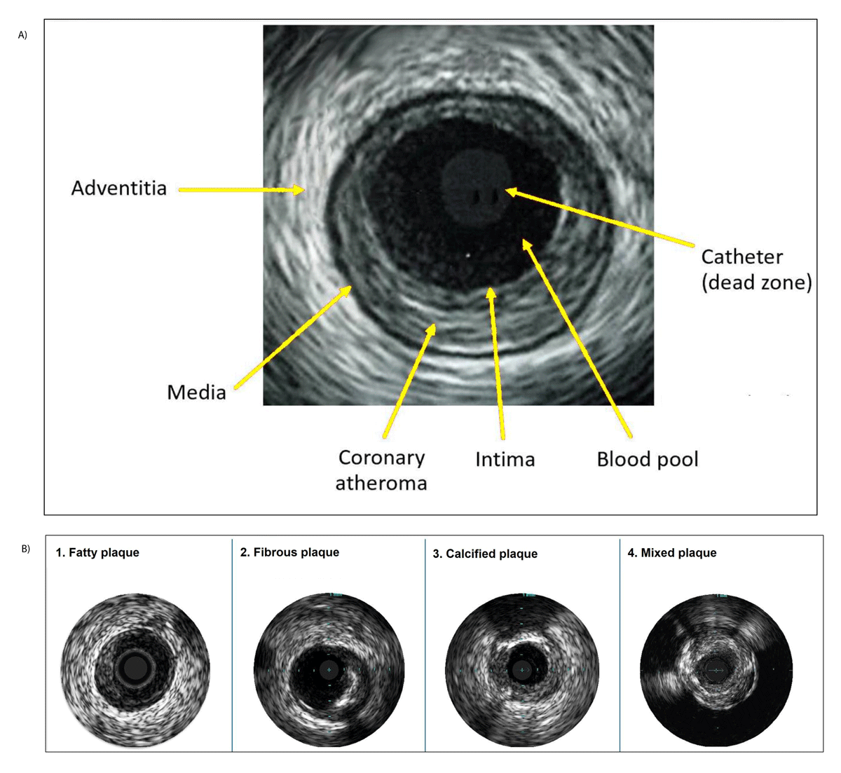Intravascular Ultrasound Imaging-Guided Percutaneous Coronary ...