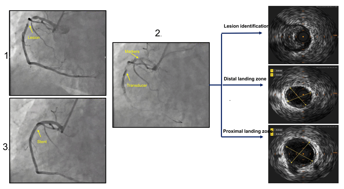 Intravascular Ultrasound Imaging-Guided Percutaneous Coronary ...