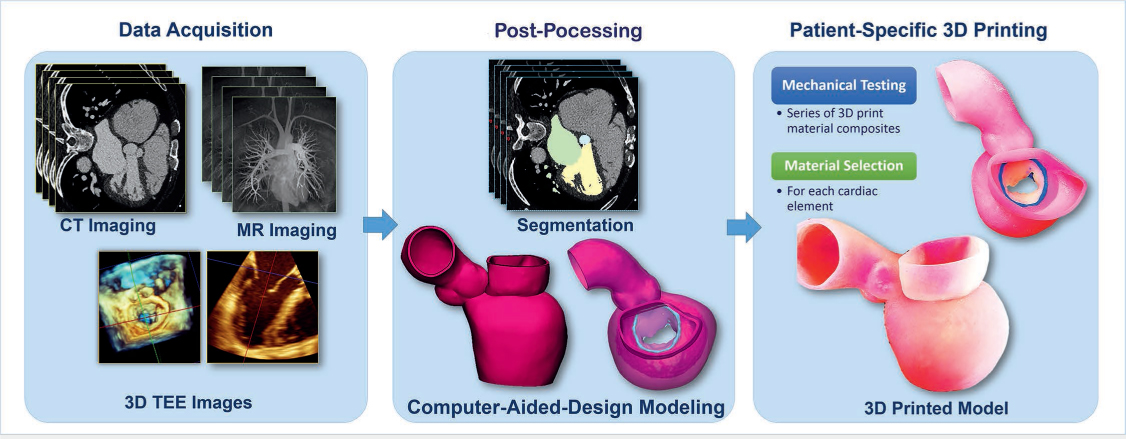 Patient-Specific Modeling for Structural Heart Intervention: Role of 3D ...