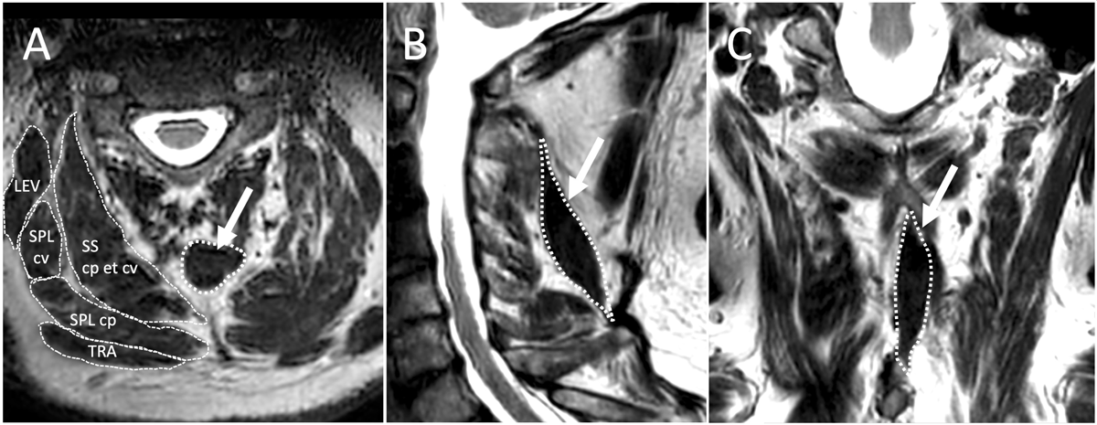 Hypertrophy of the Spinalis Cervicis Muscle in Cervical Dystonia ...