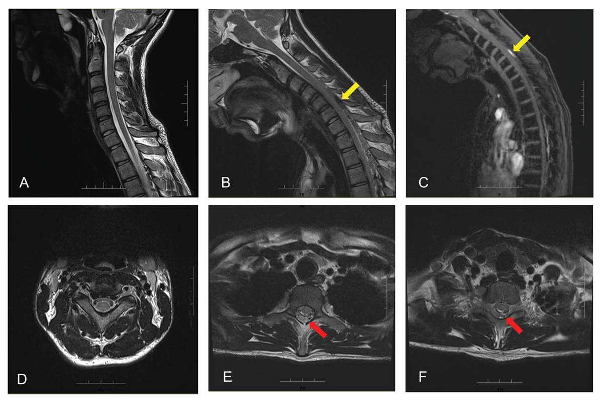 Postural Tremor Caused by Hirayama Disease Mimicking Essential Tremor ...