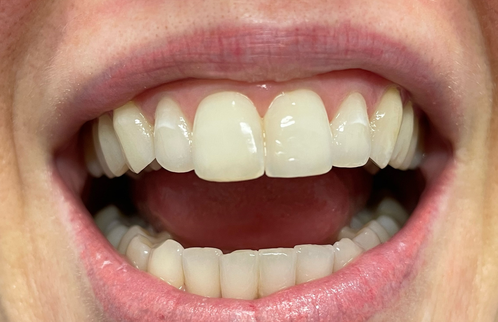 Teeth Contouring & Teeth Reshaping | Swish Dental, Brisbane