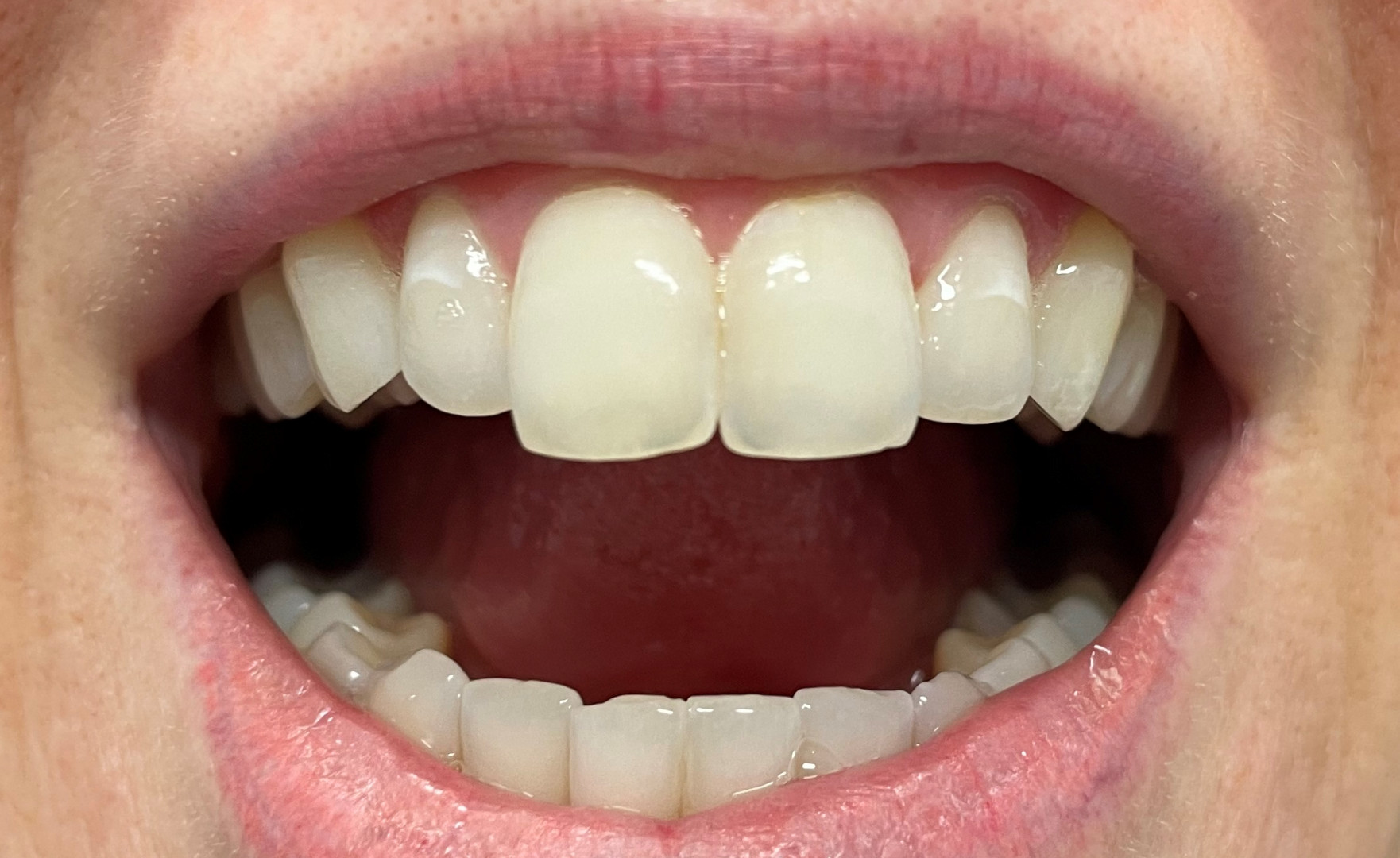 Teeth Contouring & Teeth Reshaping | Swish Dental, Brisbane