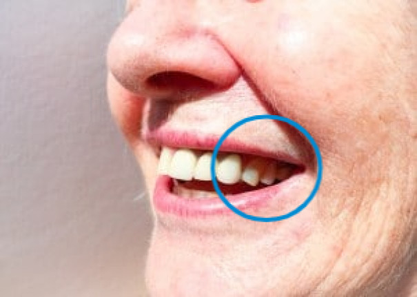 Single Tooth Denture | One tooth denture solution