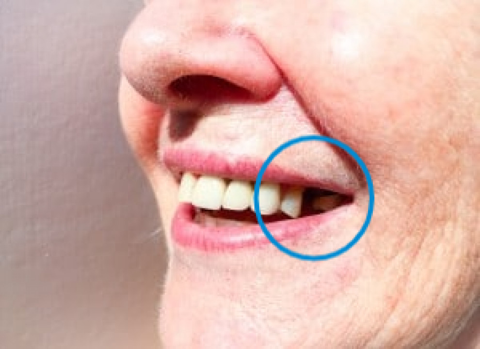 Single Tooth Denture | One tooth denture solution