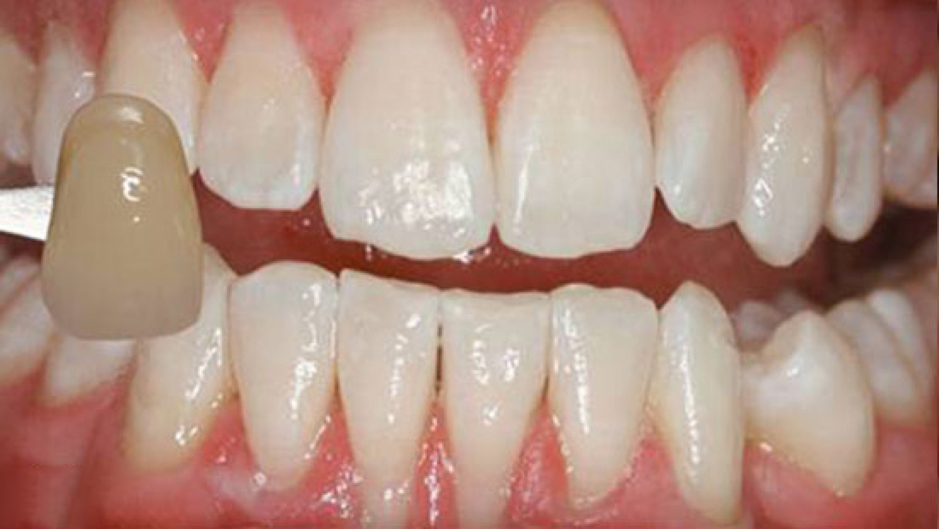 Teeth Whitening Brisbane | Cosmetic Treatments Swish Dental