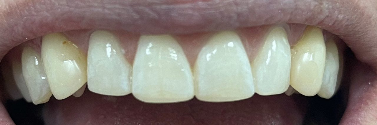 Tooth Wear in Adults & Children | Swish Dental, Brisbane