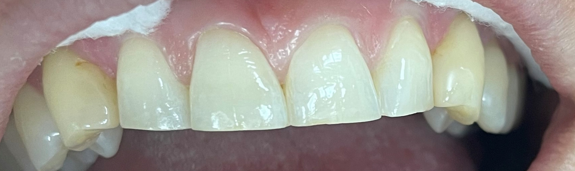 Tooth Wear in Adults & Children | Swish Dental, Brisbane