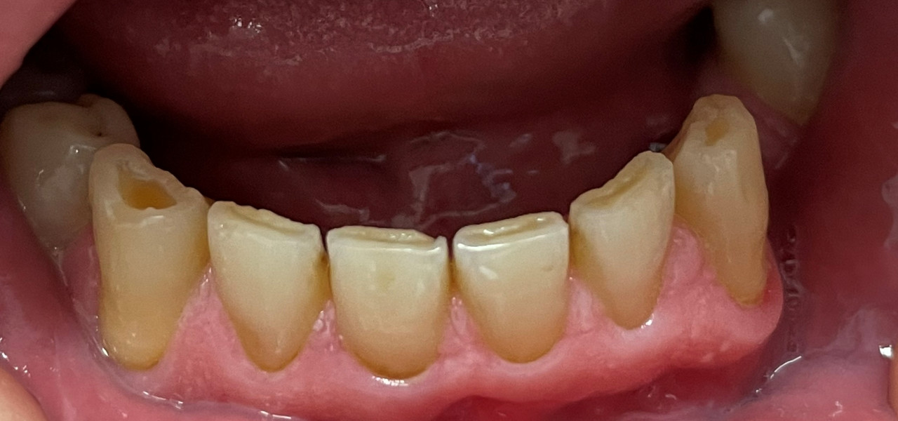 Tooth Wear in Adults & Children | Swish Dental, Brisbane