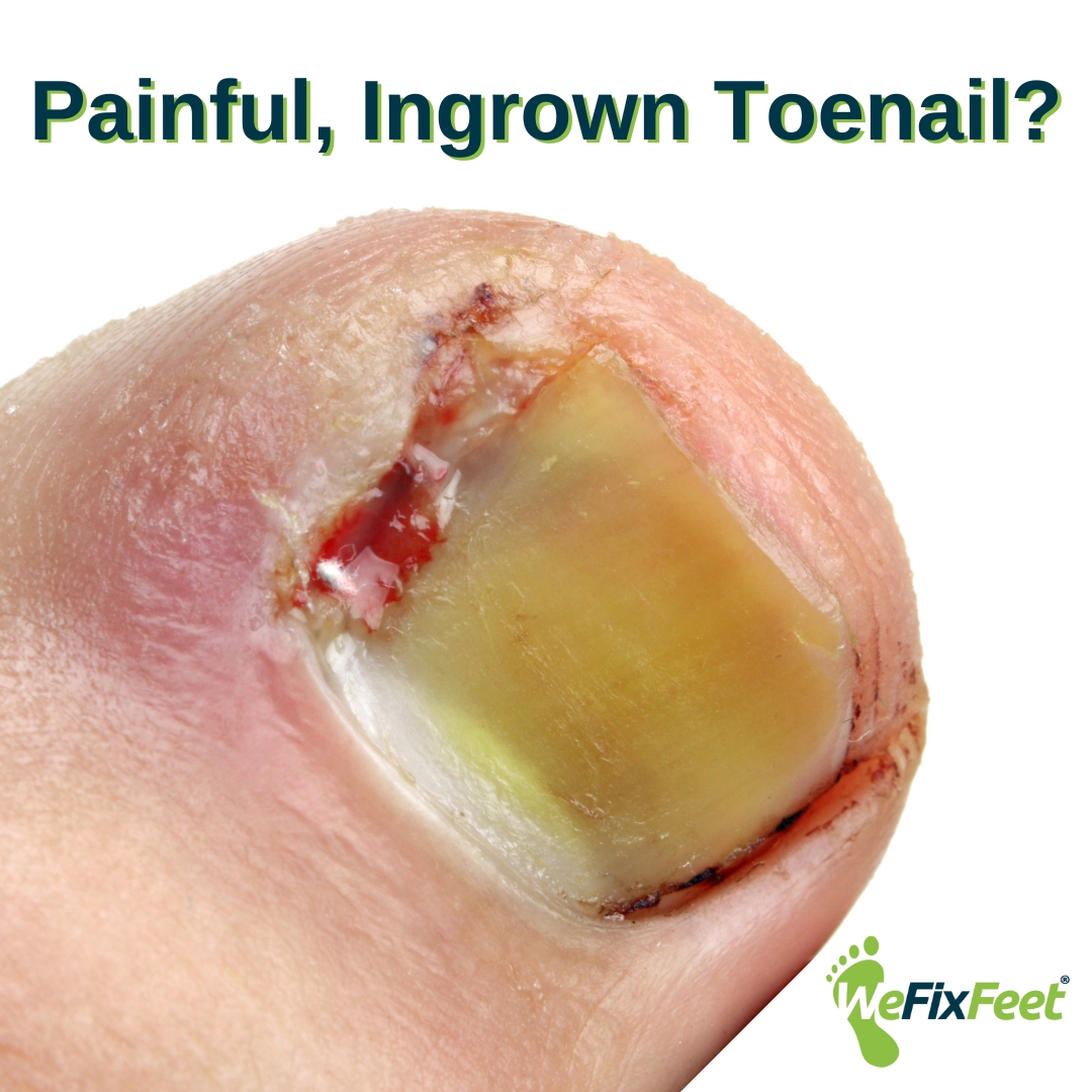 Ingrown Toenail Treatment - We Fix Feet