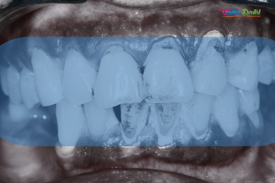 🦷 Mastering D4910: How to Properly Use the Periodontal Maintenance Code ...