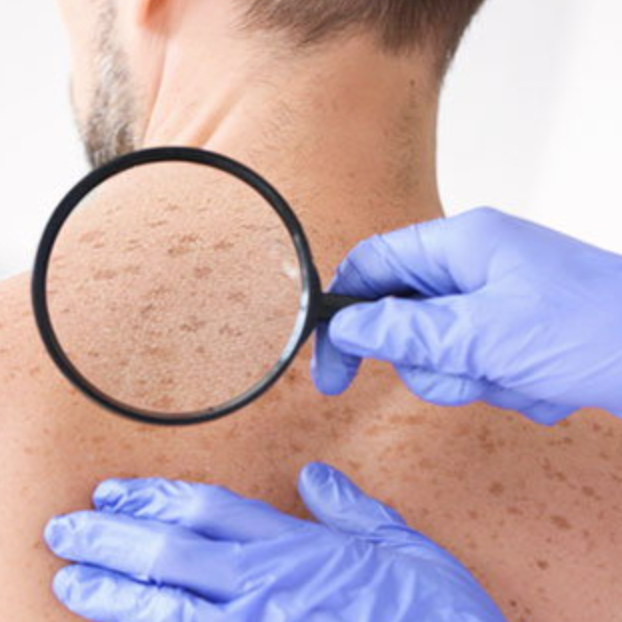 Lentigo: Causes, Symptoms, Diagnosis, and Treatment