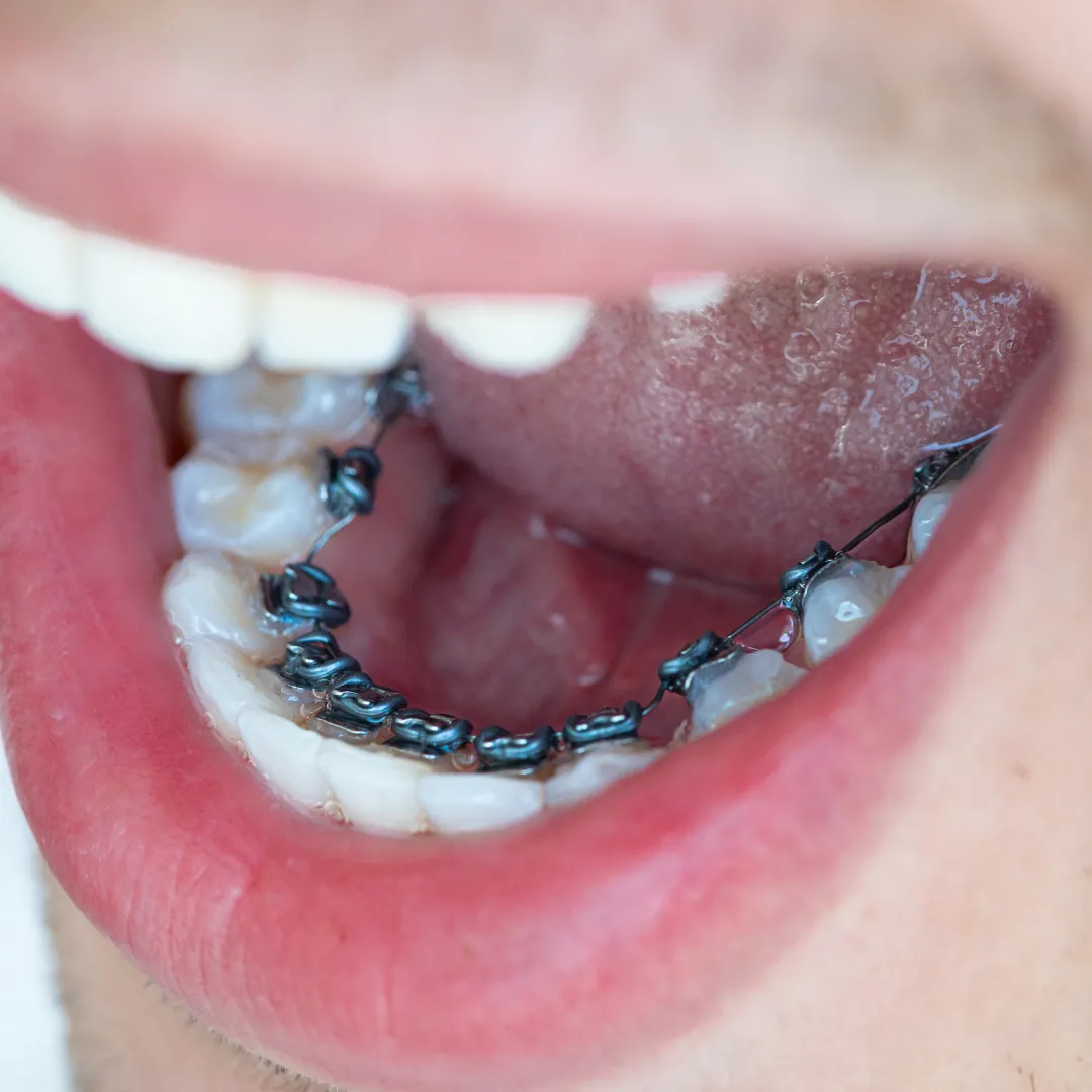 Todo lo que necesitas saber sobre los Frenillos Linguales