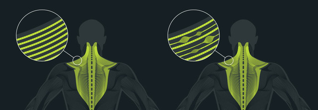 Triggerpunktmassage: Anwendung und Wirkung