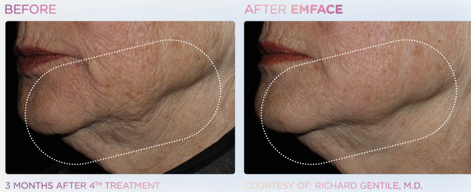 EMFACE價錢多少？花十萬做值得嗎？和鳳凰、海芙比差在哪？ - PinMed