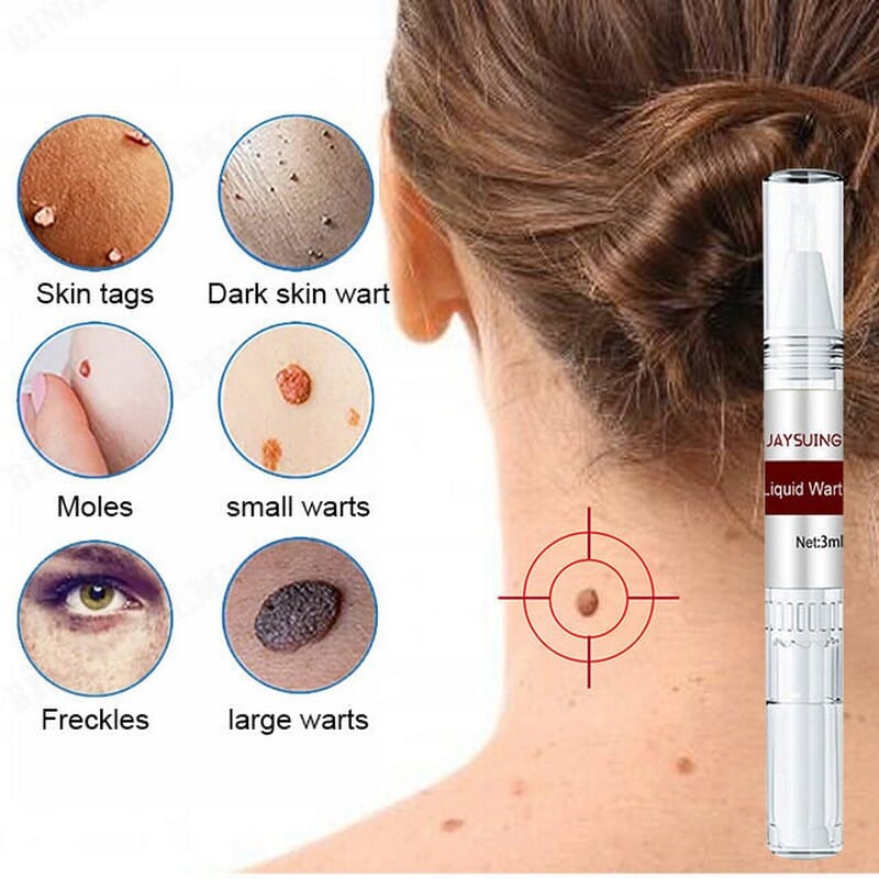 Best deals for Jaysuing Wart Removal Liquid Pen Skin Tag Removal Liquid ...