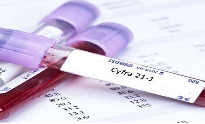 Cyfra 21-1 Test For Lung Cancer Diagnosis