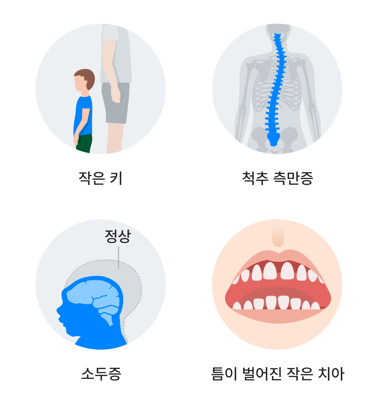 희귀질환이 궁금해 (1) MOPD II | 희귀질환 - 레어노트