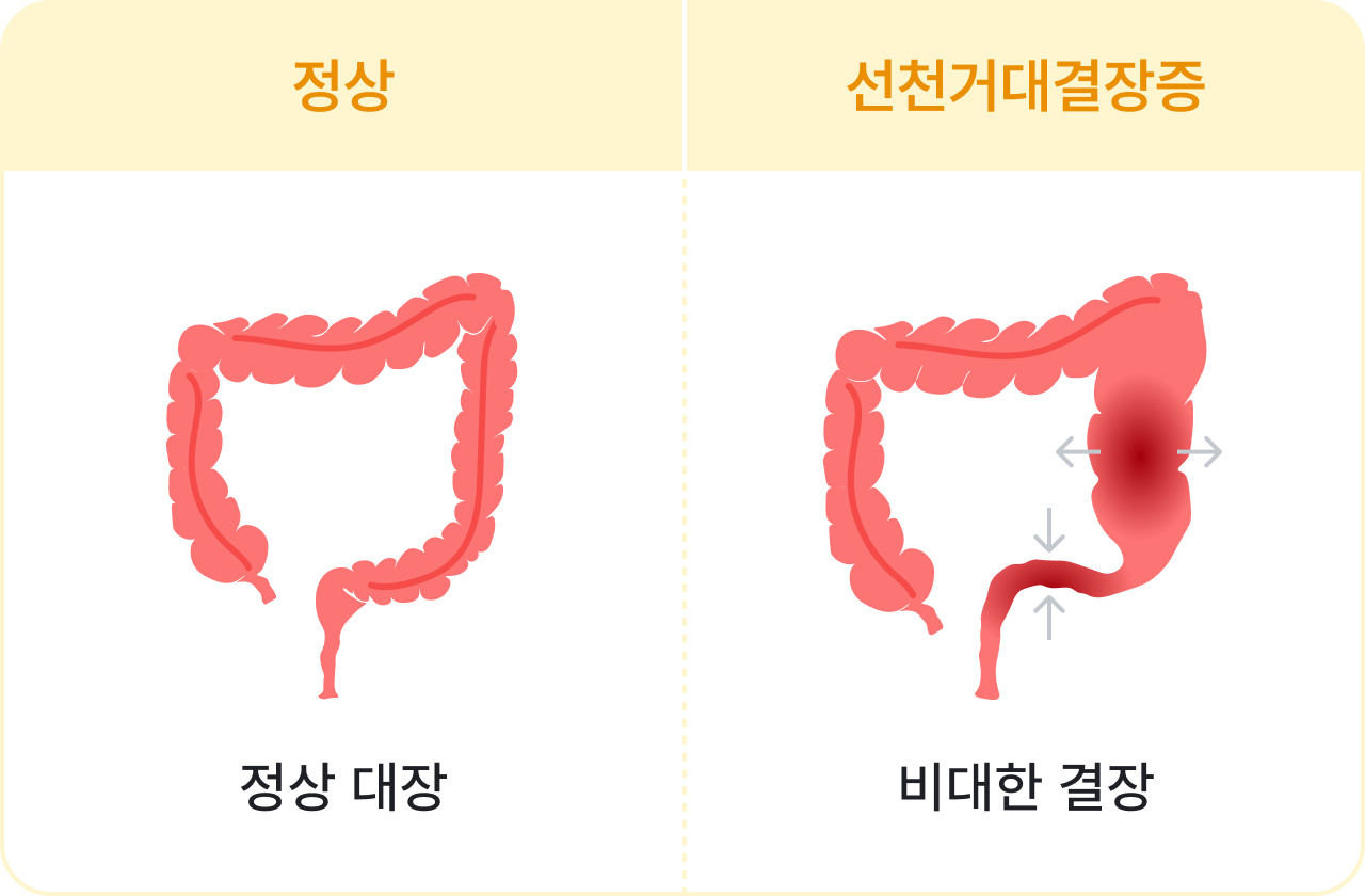 희귀질환이 궁금해 (2) 모왓-윌슨 증후군 | 희귀질환 - 레어노트