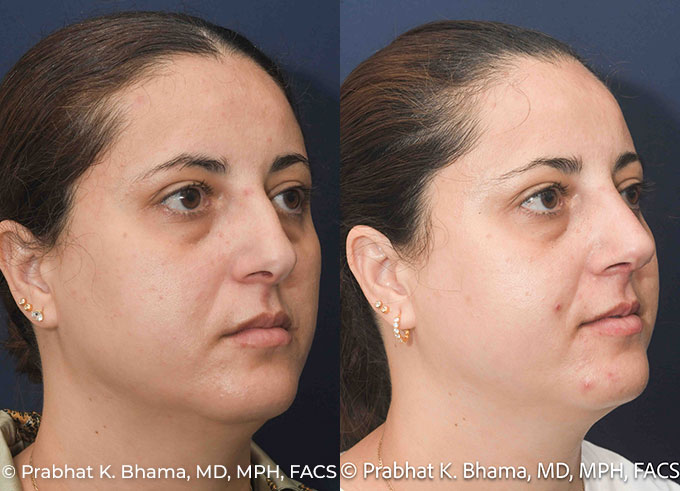 Rhinoplasty Recovery