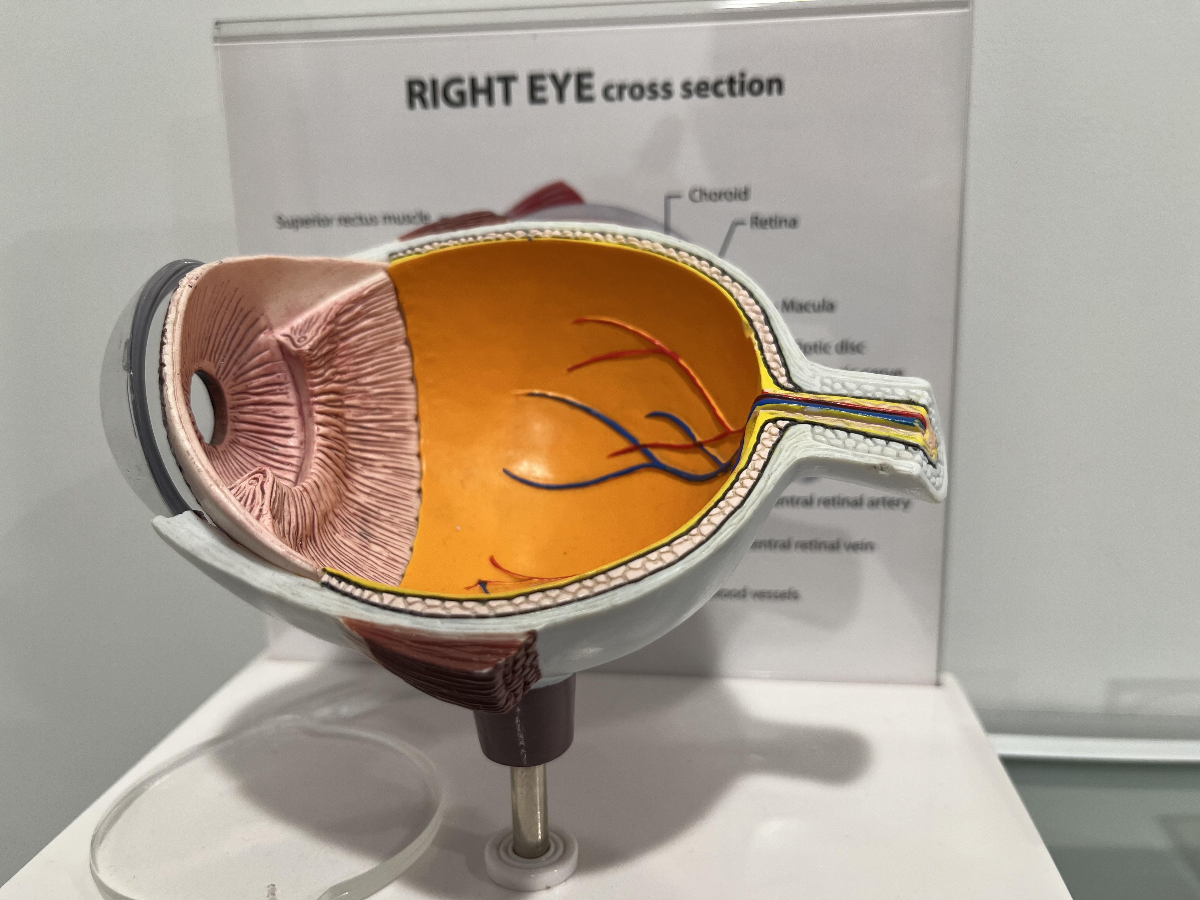 Laser Floater Treatment