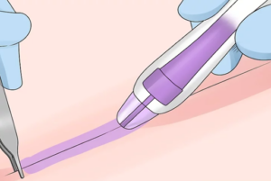 How to Care for Your Child with Laceration (cuts) - Sidra Medicine