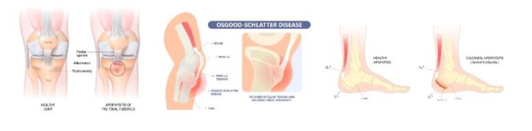 How to Care for Your Child with Apophysitis - Sidra Medicine