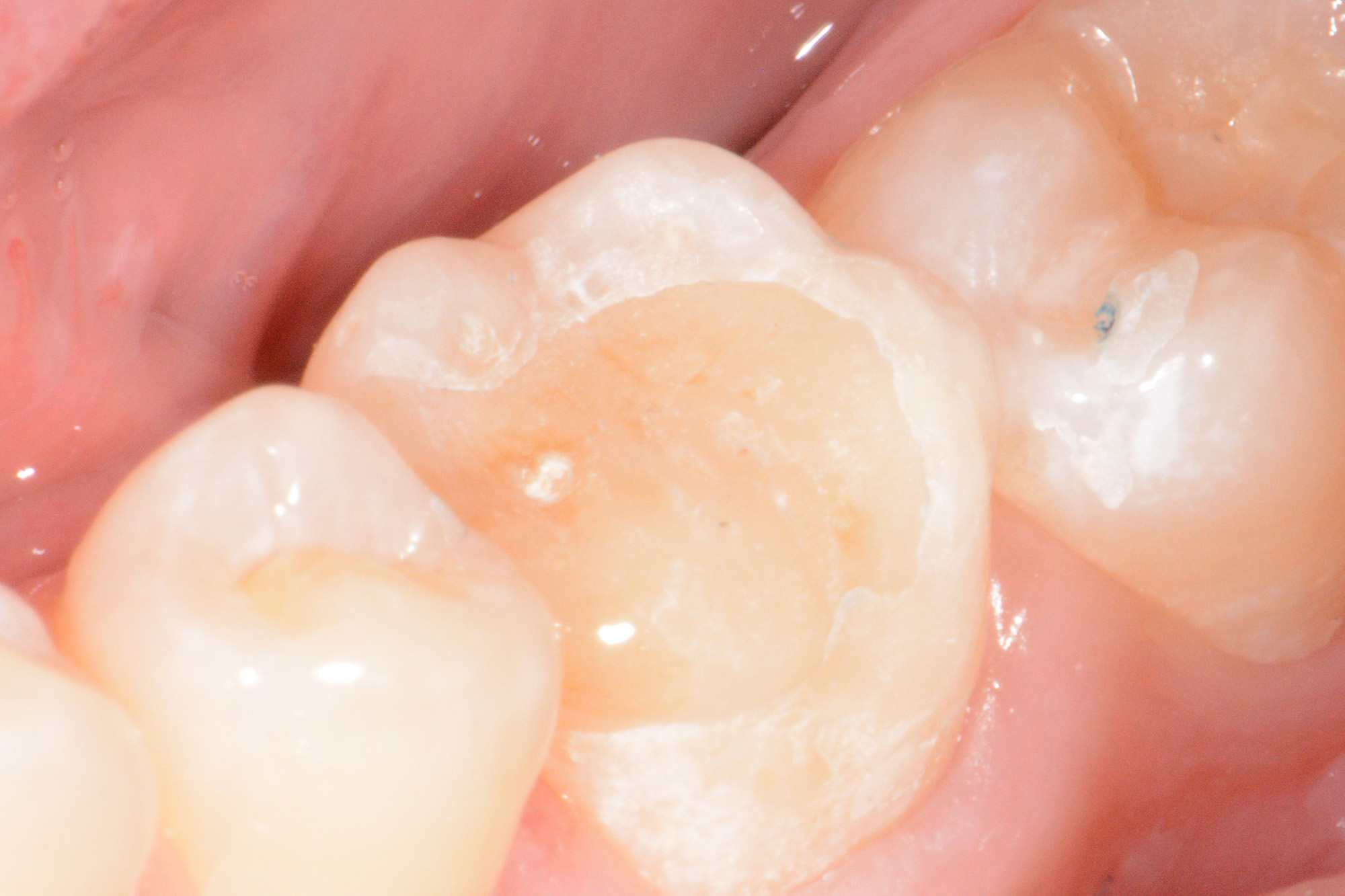 Partial Crown — Smile to Me