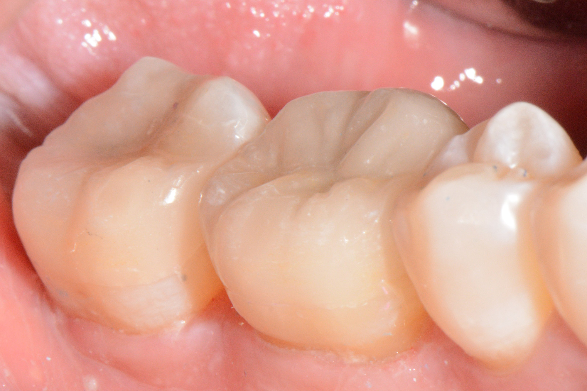 Partial Crown — Smile to Me