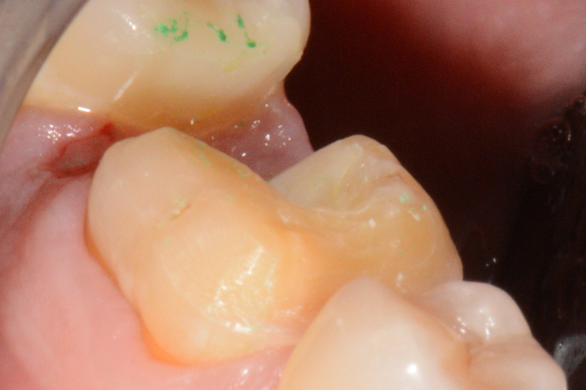 Partial Crown — Smile to Me